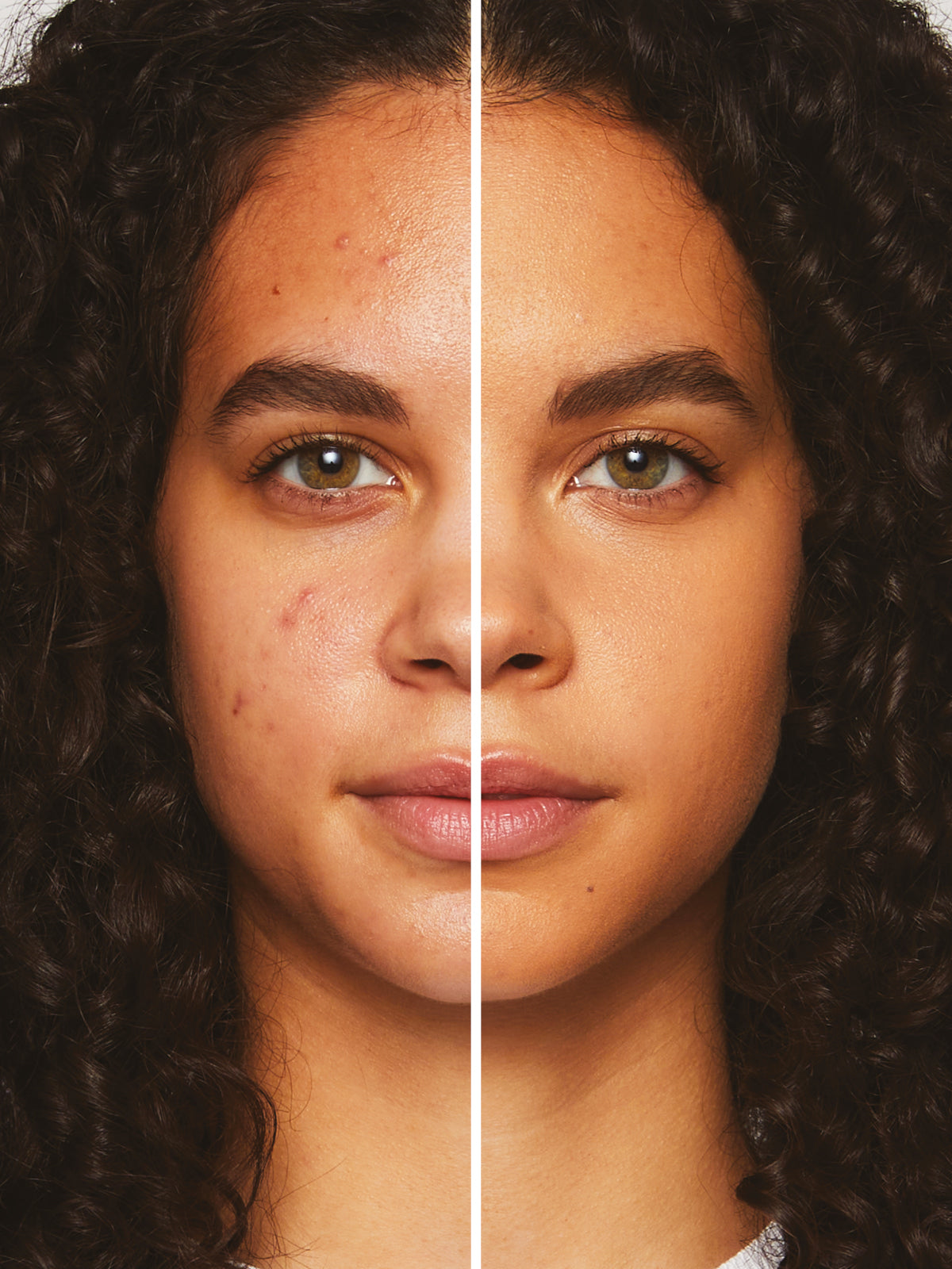 Acne og bumser kan med fordel skjules